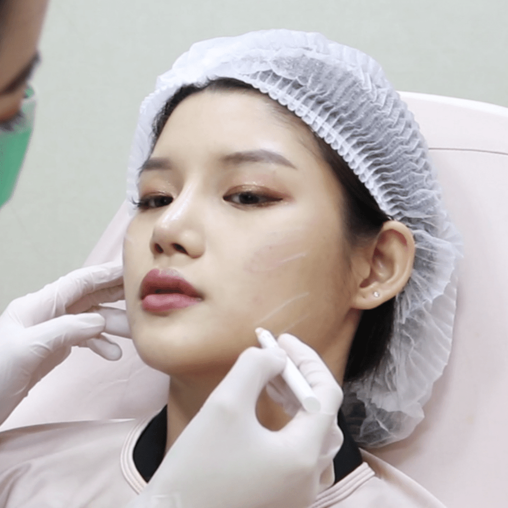 Lipo X Silk Injection To Dissolve Fat, Reshape The Face, Reduce ...