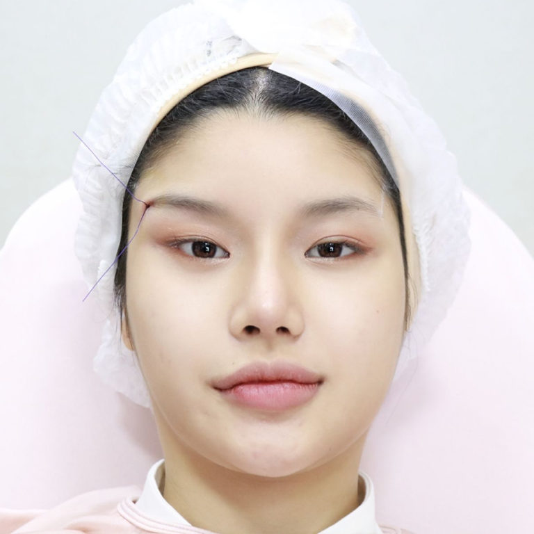 ENDOLINE FOXY EYES – Waleerat Clinic