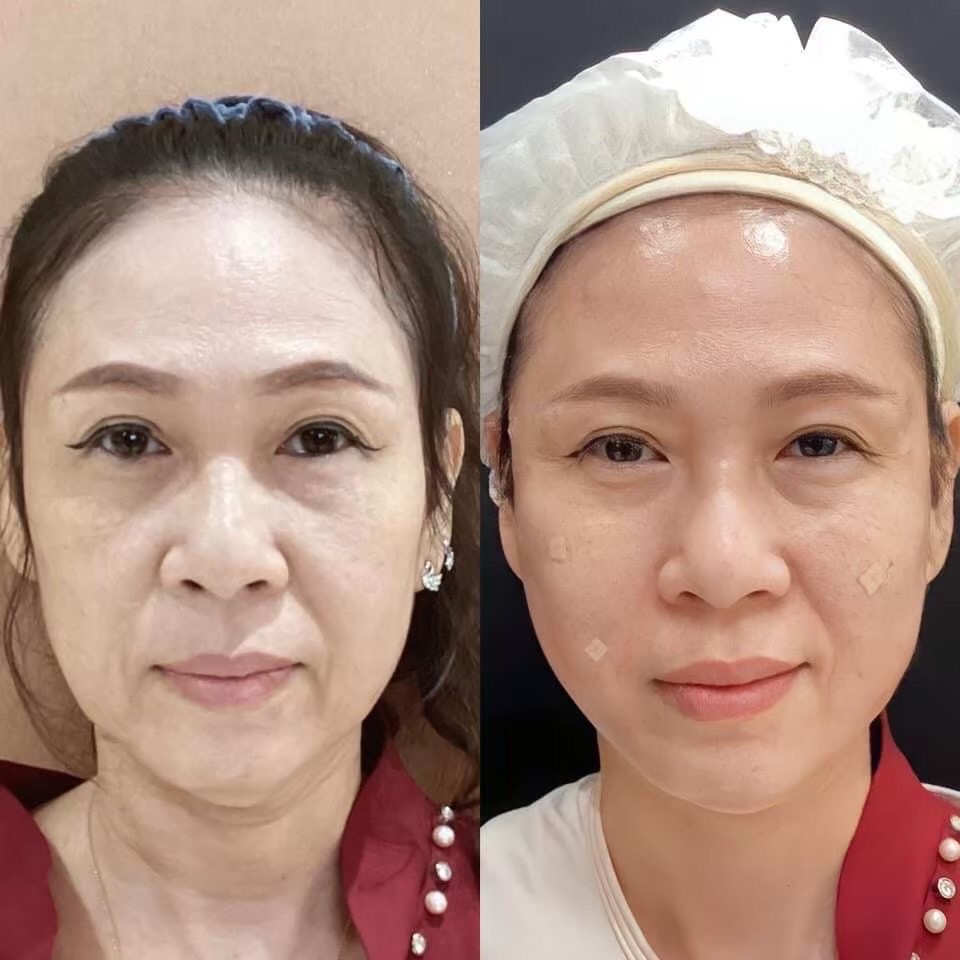 Radiesse Filler » Radiesse-filler